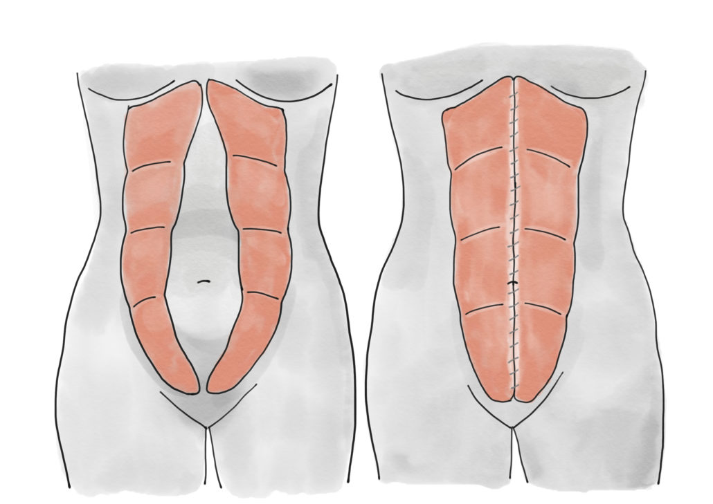 Ratgeber Rectusdiastase Bei M ttern MamaWORKOUT